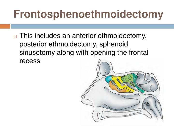 Ppt Endoscopic Sinus Surgery Powerpoint Presentation Id 153924