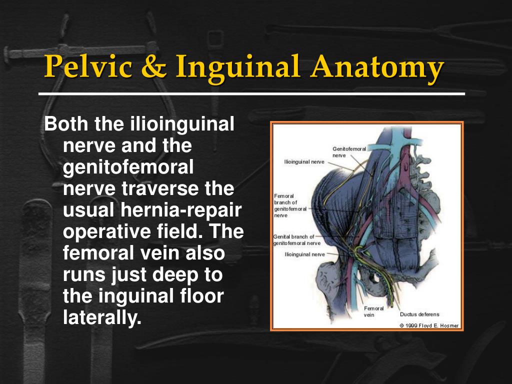 Ppt Inguinal Hernias Powerpoint Presentation Id 218475