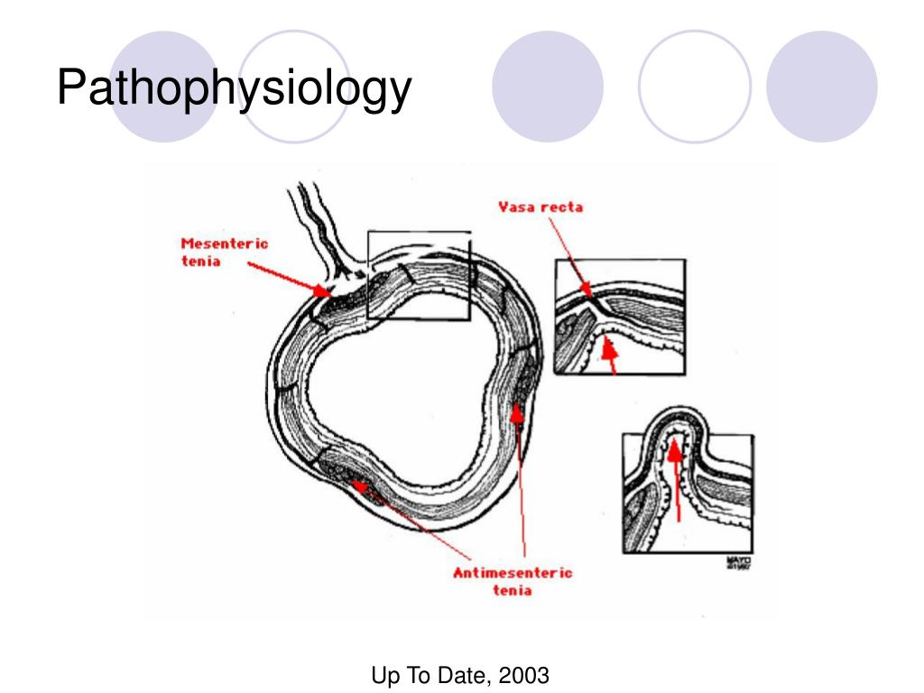 Ppt Diverticular Disease Powerpoint Presentation Id229322