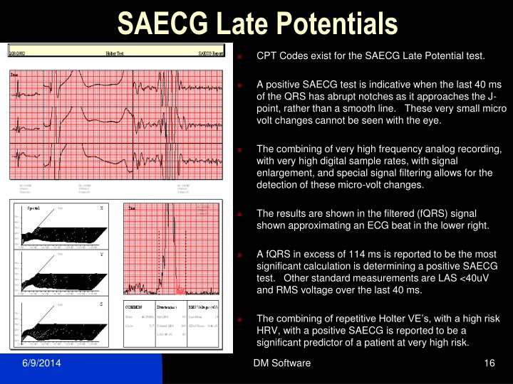 PPT - Reading the Holter ECG Report PowerPoint Presentation - ID:384785 PPT - Reading the Holter ECG Report PowerPoint Presentation - ID:384785