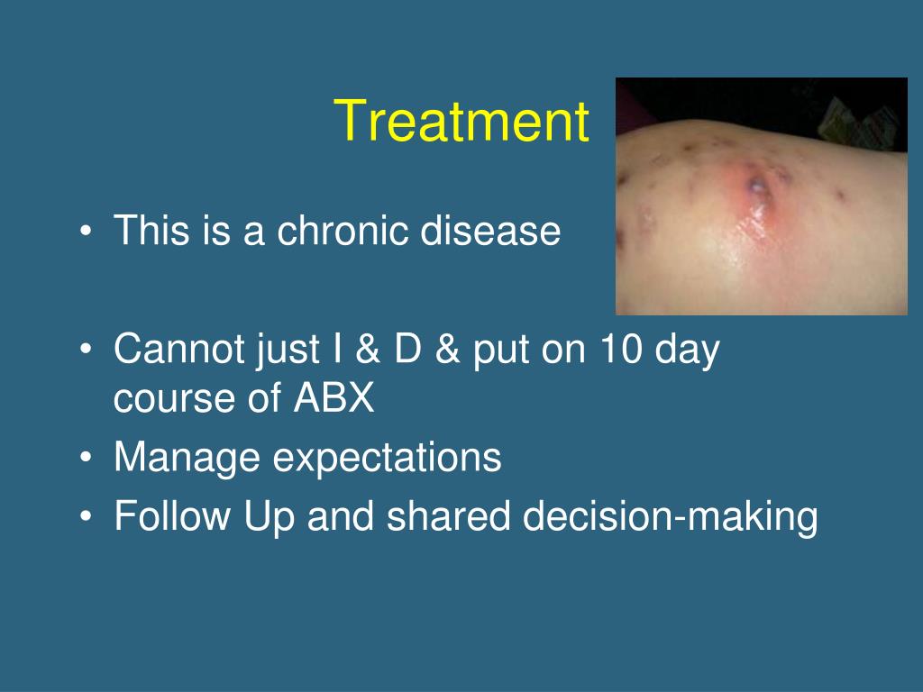 Ppt Hidradenitis Suppurativa Powerpoint Presentation Id 595951
