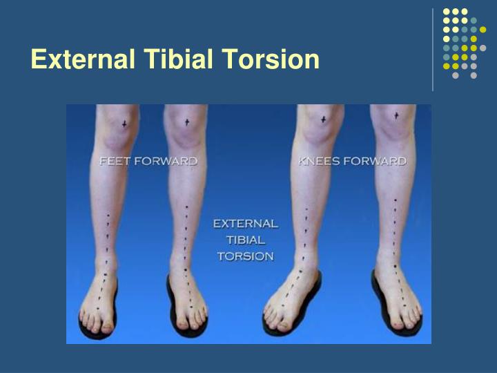 PPT - Rotational and Angular Deformities in Children PowerPoint ...