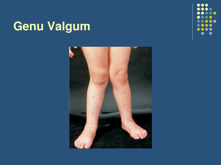 PPT - Rotational and Angular Deformities in Children PowerPoint ...