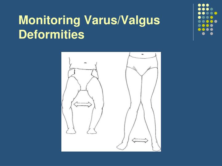 PPT - Rotational and Angular Deformities in Children PowerPoint ...