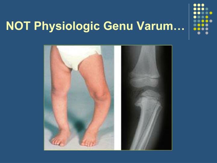 PPT - Rotational and Angular Deformities in Children PowerPoint ...