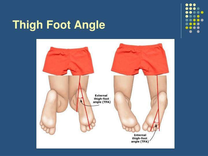 PPT - Rotational and Angular Deformities in Children PowerPoint ...