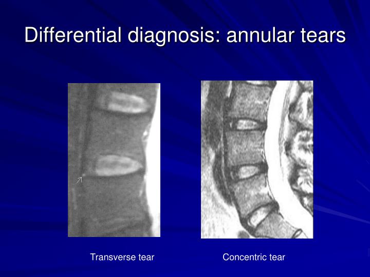PPT - The “Dehydrated” Lumbar Intervertebral Disk on MR, its anatomy ...