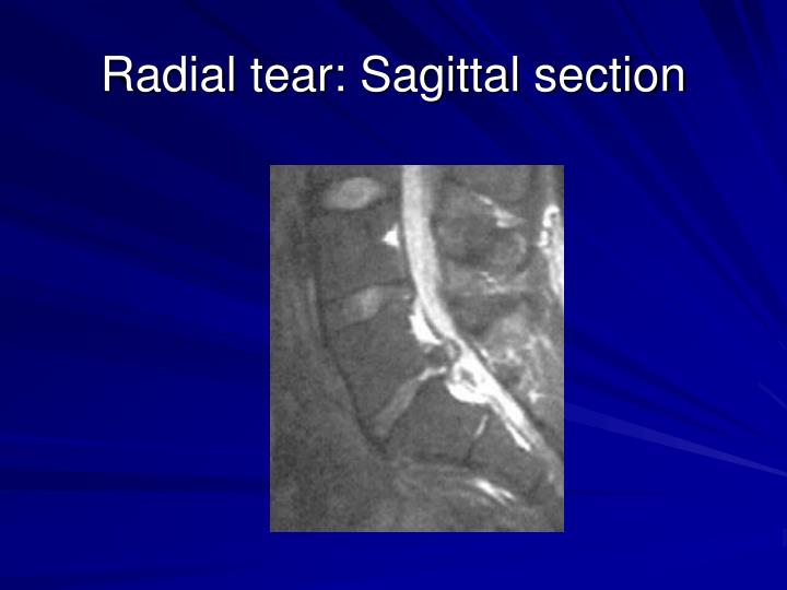 PPT - The “Dehydrated” Lumbar Intervertebral Disk on MR, its anatomy ...