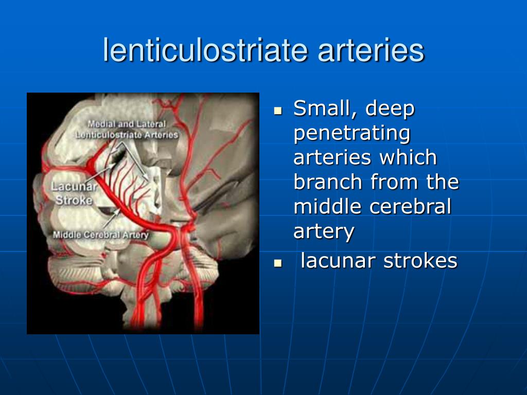 Lenticulostriate Arteries Stroke