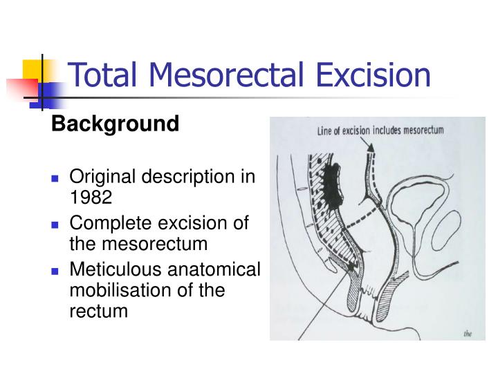 PPT - Total Mesorectal Excision PowerPoint Presentation - ID:1015380