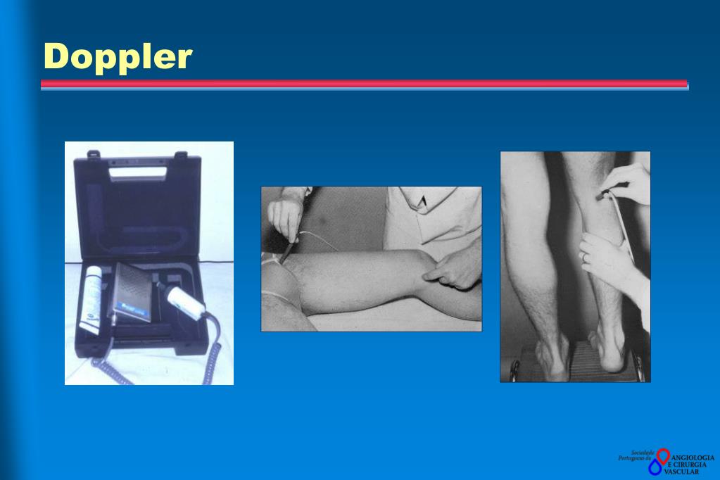 PPT - Doença arterial obstrutiva periférica (DAOP) PowerPoint ...