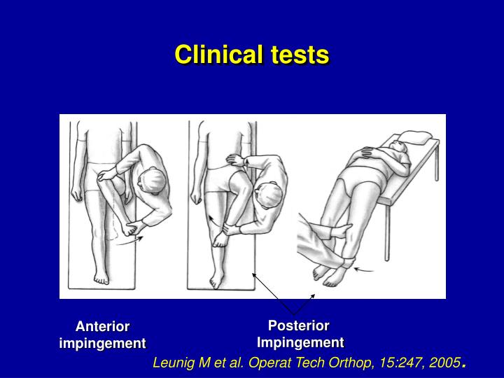 PPT - Diagnosis and Management of Femoroacetabular Impingement (FAI ...