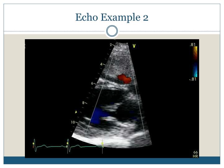 PPT - Ventricular Septal Defects PowerPoint Presentation - ID:1030449