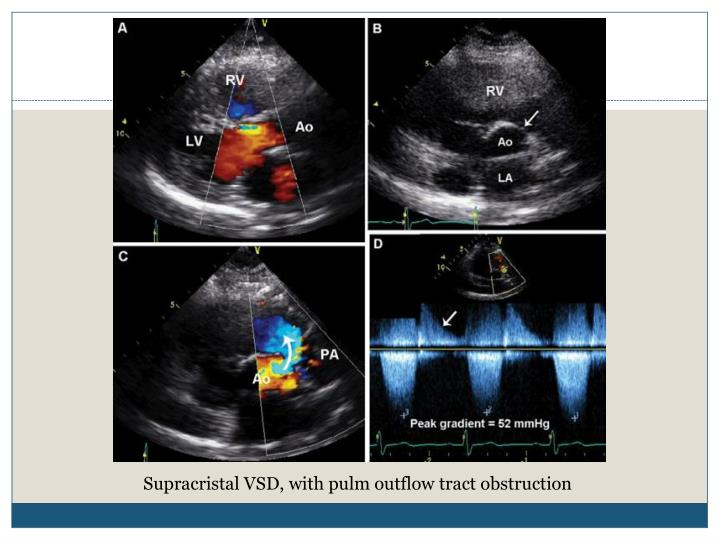 PPT - Ventricular Septal Defects PowerPoint Presentation - ID:1030449