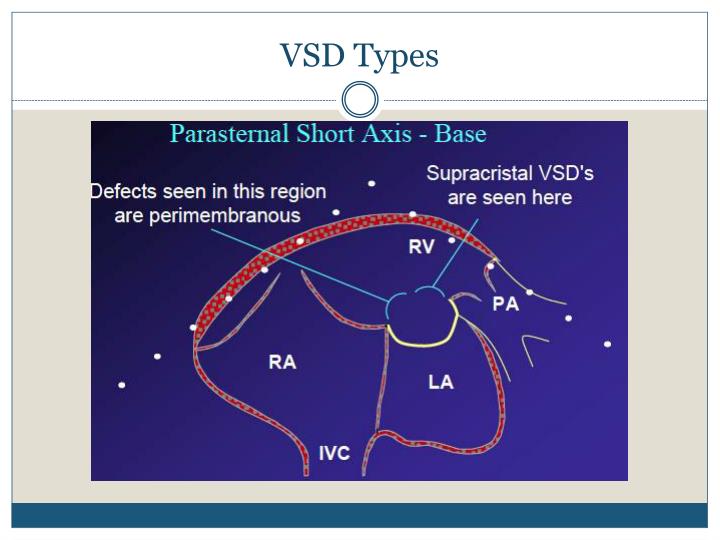 PPT - Ventricular Septal Defects PowerPoint Presentation - ID:1030449