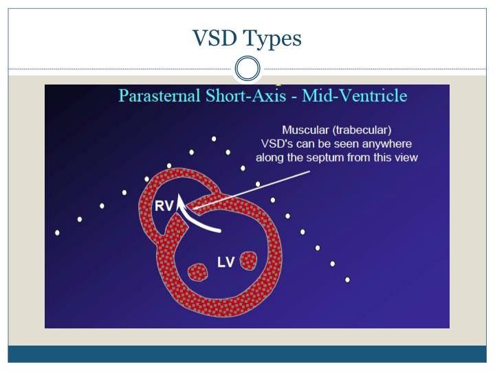 PPT - Ventricular Septal Defects PowerPoint Presentation - ID:1030449