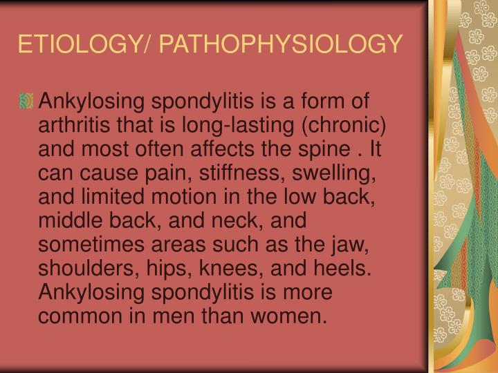 PPT - Ankylosing Spondylitis PowerPoint Presentation - ID:1039958