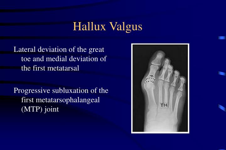 PPT - Hallux Valgus PowerPoint Presentation - ID:1046068