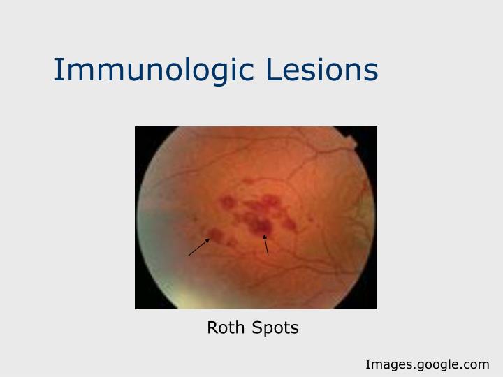 PPT - Infective Endocarditis PowerPoint Presentation - ID:1048982