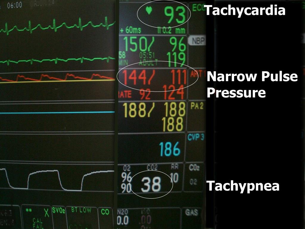 PPT - TRAUMA Stab Wound to the Chest: Cardiac Tamponade PowerPoint ...