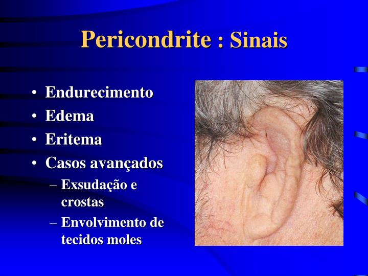 PPT - PATOLOGIAS DA ORELHA EXTERNA PowerPoint Presentation - ID:1051443