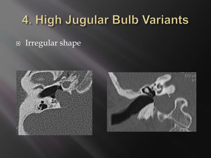 PPT - The Large Vestibular Aqueduct Syndrome in adults PowerPoint ...