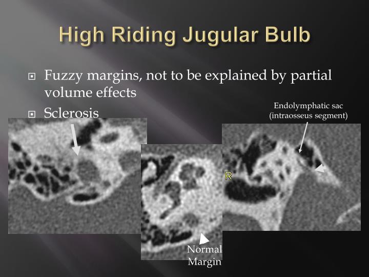 PPT - The Large Vestibular Aqueduct Syndrome in adults PowerPoint ...