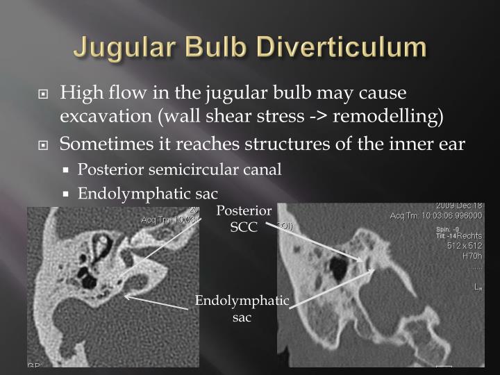 PPT - The Large Vestibular Aqueduct Syndrome in adults PowerPoint ...