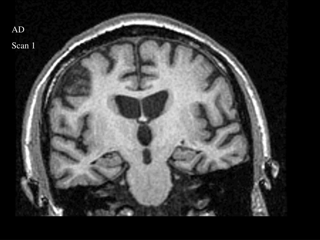 PPT - MRI, rates of atrophy and Alzheimer’s disease PowerPoint ...