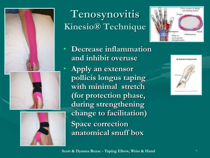 PPT - Therapeutic Taping for the Elbow, Wrist and Hand PowerPoint ...