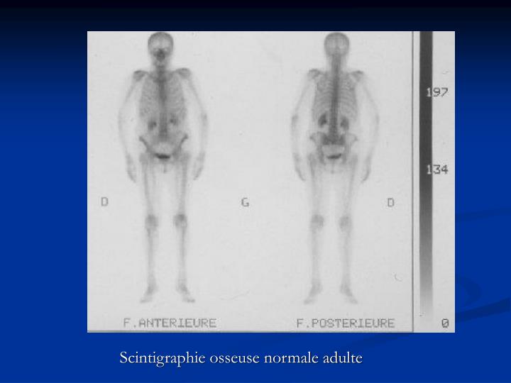 PPT - La scintigraphie osseuse PowerPoint Presentation - ID:1058823