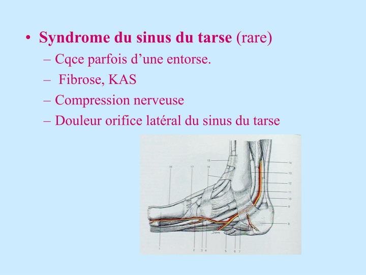 PPT - Entorse de la Cheville, PowerPoint Presentation - ID:1063455