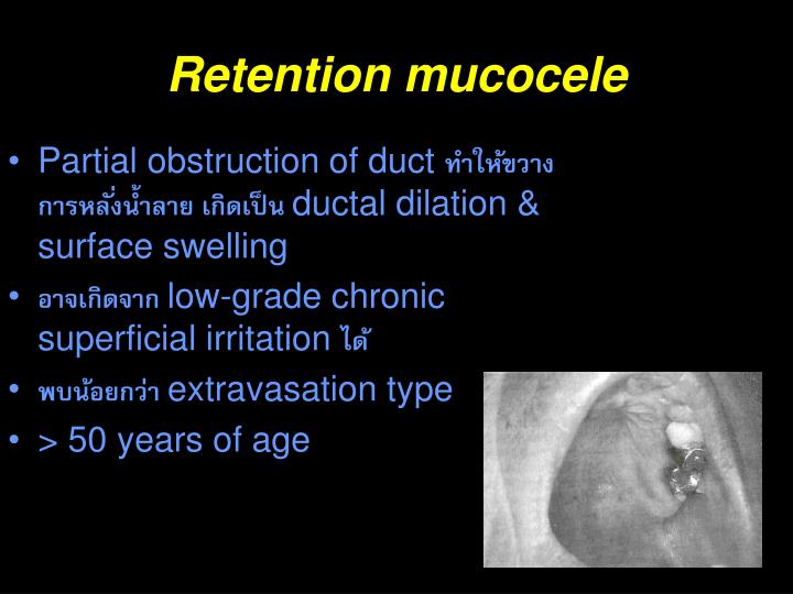 PPT - MUCOCELE & RANULA PowerPoint Presentation - ID:1067382