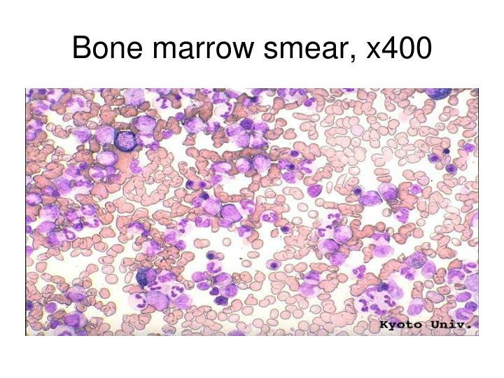 Bone Marrow Smear