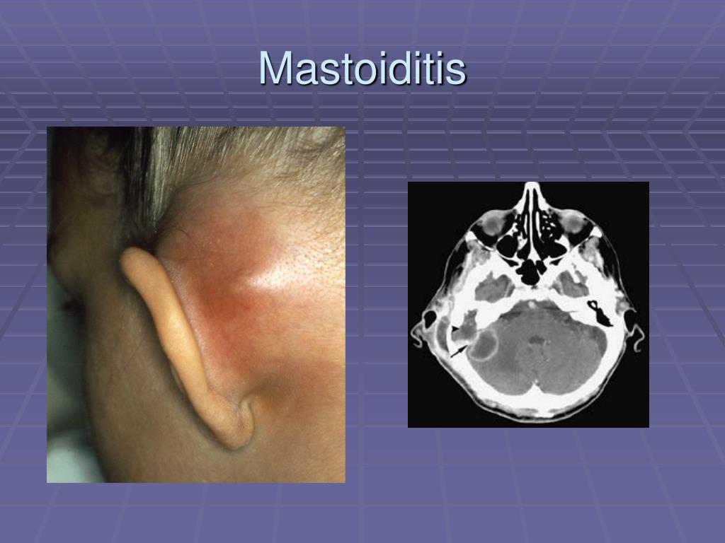 PPT Mastoids And Organs Of Hearing PowerPoint Presentation Free