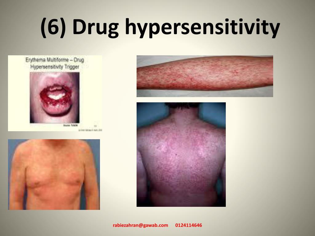 Ppt Pruritus A Manifestation Of Systemic Disease Powerpoint