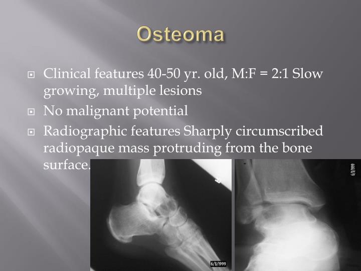PPT - Review of Benign Bone TUMORS PowerPoint Presentation - ID:1074327