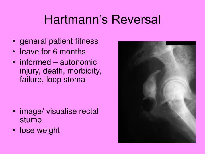 PPT - Acute Diverticulitis & Hartmann’s Procedure PowerPoint ...