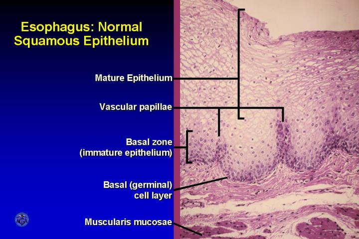 PPT - Esophagus: Normal Lower Esophageal and Squamo-columnar Junction ...