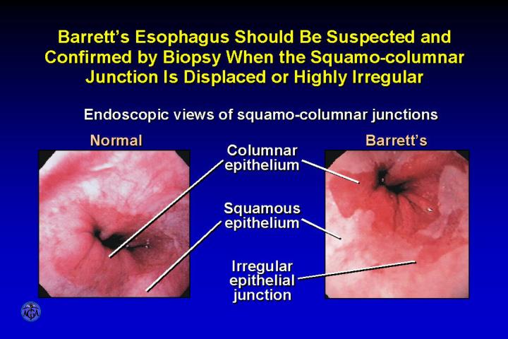 PPT - Esophagus: Normal Lower Esophageal and Squamo-columnar Junction ...