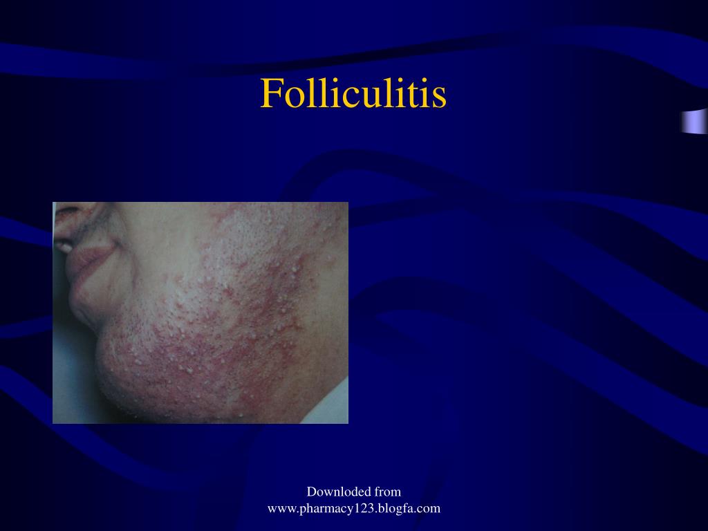 PPT - Management of Common Fungal & Bacterial Skin Infections ...