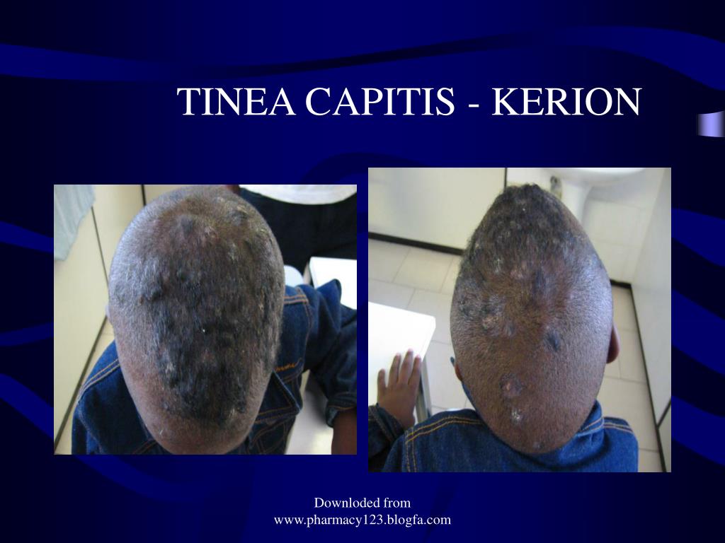 PPT - Management of Common Fungal & Bacterial Skin Infections ...