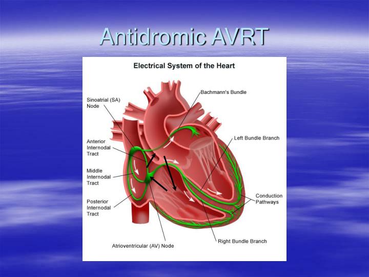 PPT - Junctional Rhythms / A-V Nodal Rhythm PowerPoint Presentation ...
