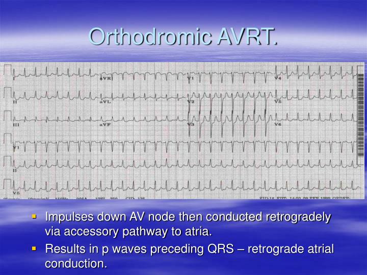 PPT - Junctional Rhythms / A-V Nodal Rhythm PowerPoint Presentation ...