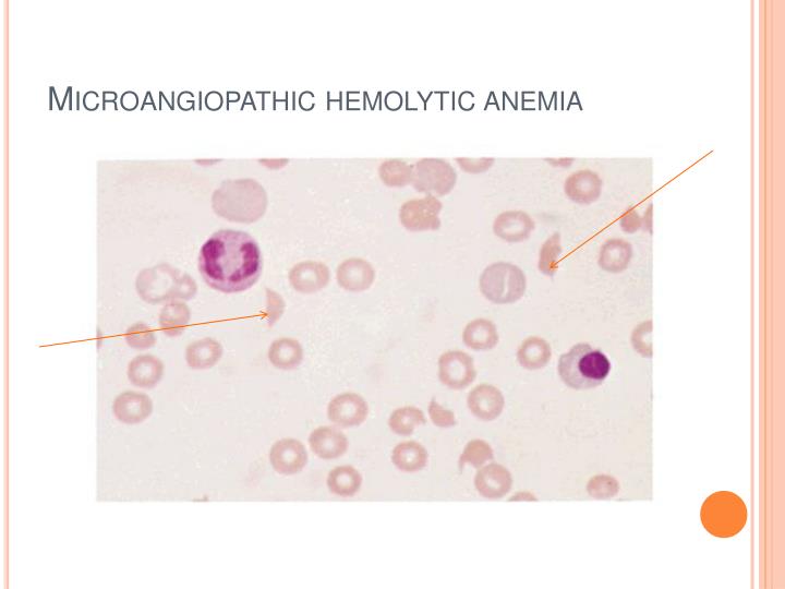 PPT - Approach to hemolytic anemia PowerPoint Presentation - ID:1092240