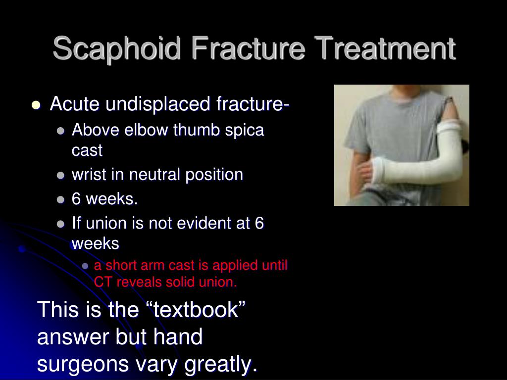 Scaphoid Fracture Causes Symptoms And Treatment
