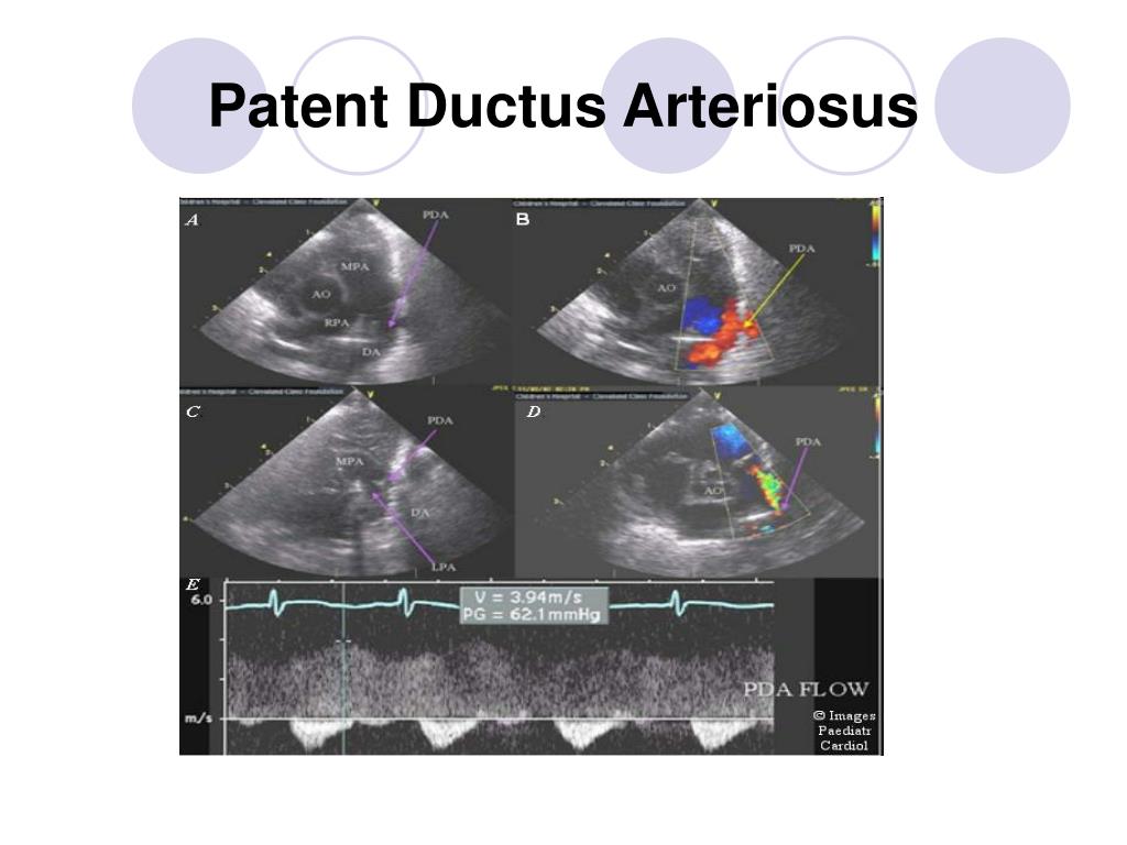 Ppt Patent Ductus Arteriosus Powerpoint Presentation Free Download
