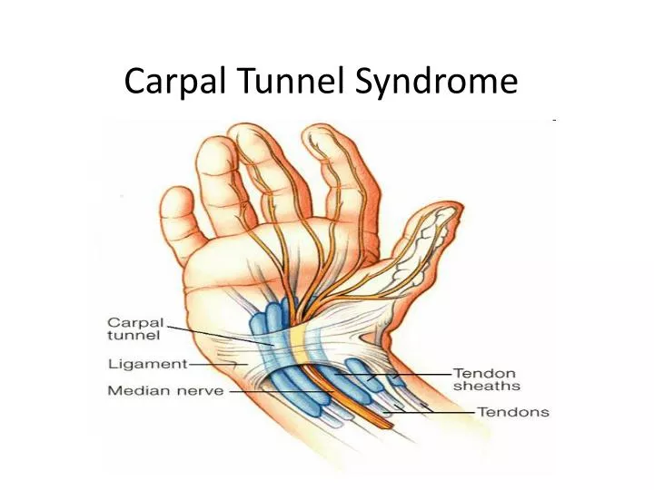 PPT - Carpal Tunnel Syndrome PowerPoint Presentation, free download - ID:1096878
