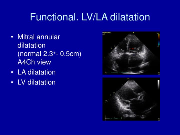 PPT - How to Diagnose and Assess Severity of Mitral Regurgitation by ...