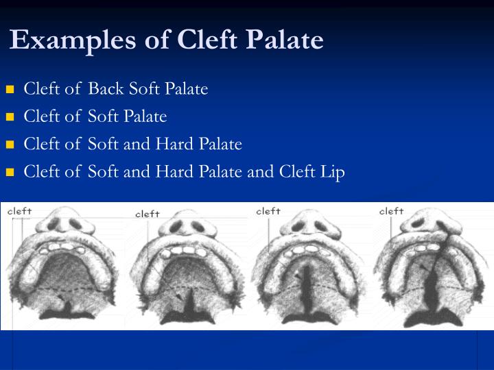 PPT - Cleft Lip & Palate PowerPoint Presentation - ID:1098085